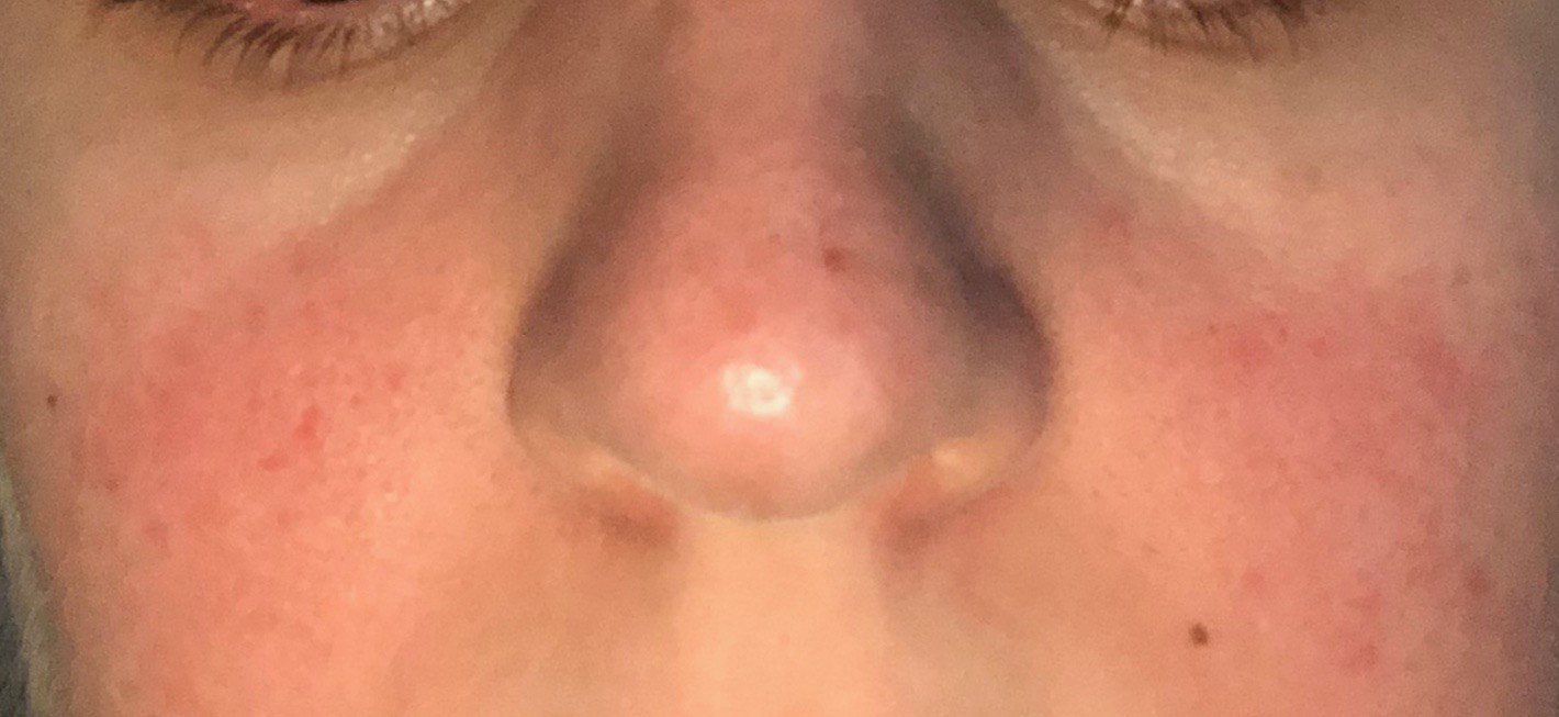 PDT: PhotoDynamic Laser Therapy - Dr. Tom Yarema, M.D.