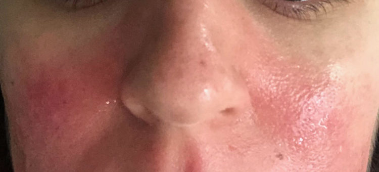 PDT: PhotoDynamic Laser Therapy - Dr. Tom Yarema, M.D.